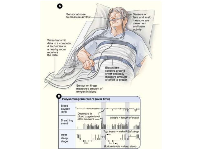 Role of mandibular advancement splint in sleep apnoea | PPTX | Ear ...