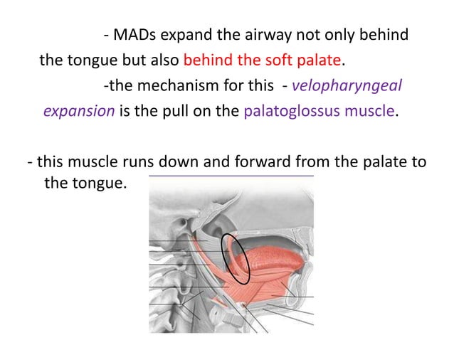 Role of mandibular advancement splint in sleep apnoea | PPTX | Ear ...