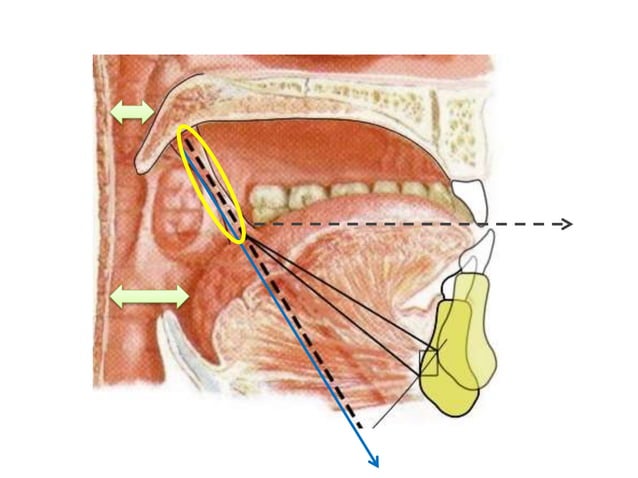 Role of mandibular advancement splint in sleep apnoea | PPTX | Ear ...