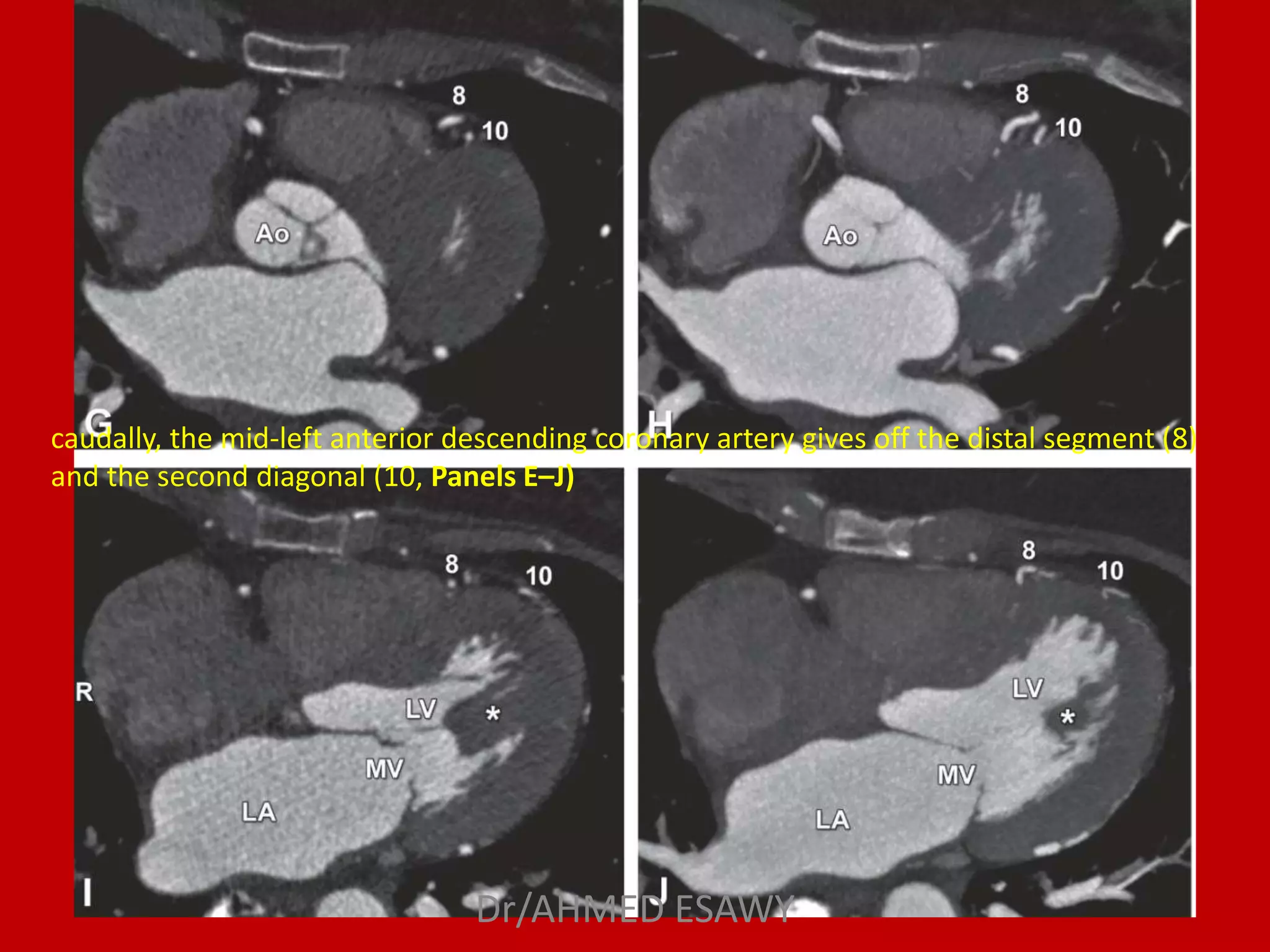 Role of MDCT in coronary artery part 1 (CT anatomy) Dr Ahmed Esawy | PPT