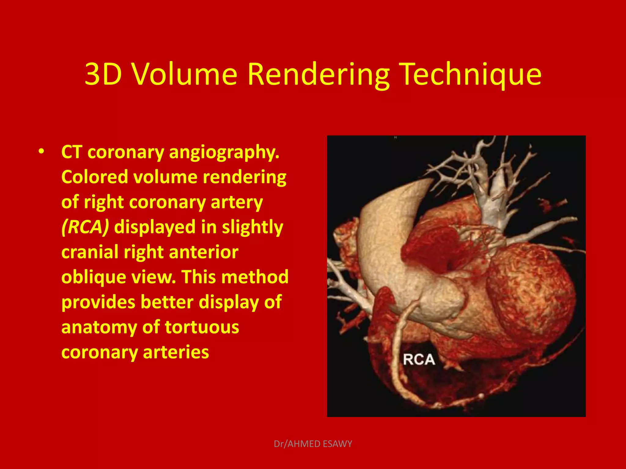 Role of MDCT multisclice CT in coronary artery part 2 (pathology ...
