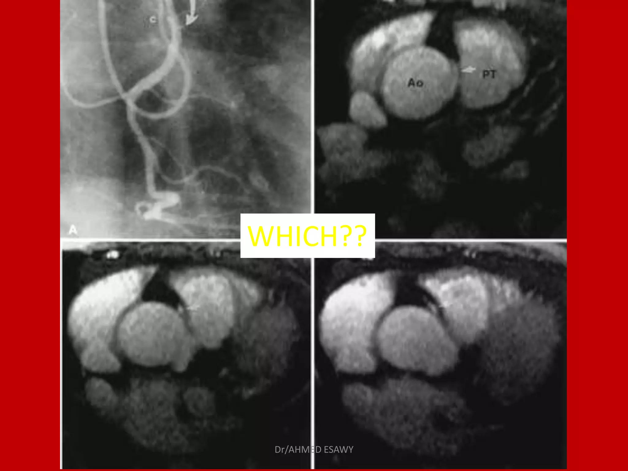 Role of MDCT MULTISCLICE CT tin coronary artery part 4 (anomalous ...
