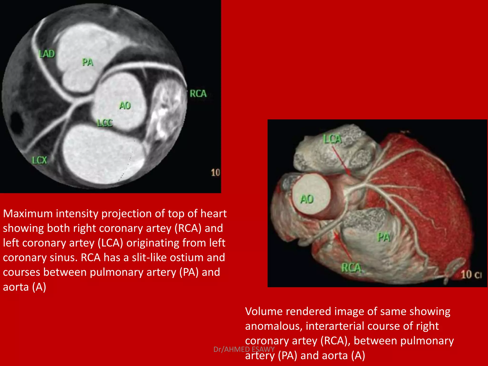 Role of MDCT MULTISCLICE CT tin coronary artery part 4 (anomalous ...