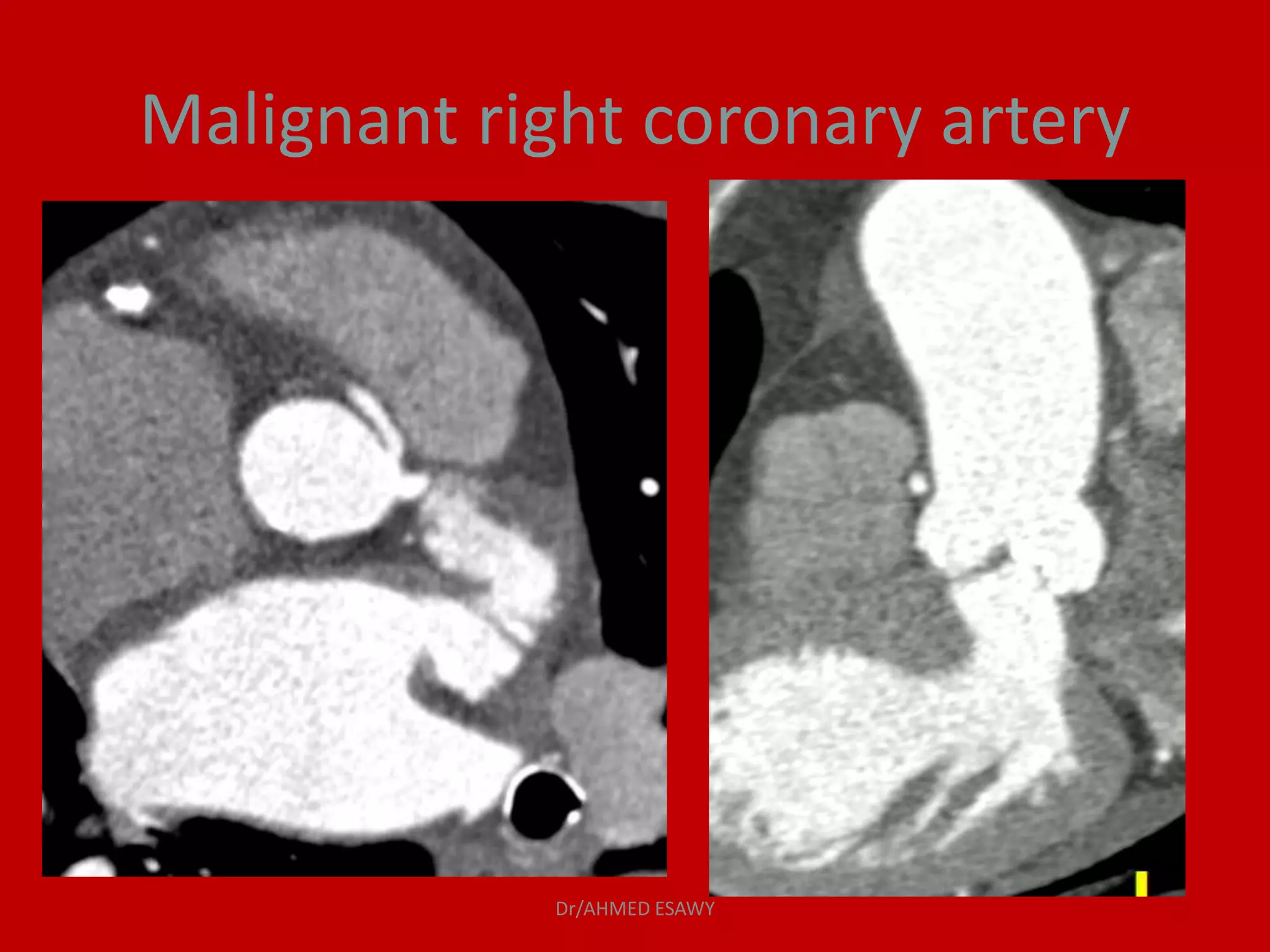 Role of MDCT MULTISCLICE CT tin coronary artery part 4 (anomalous ...