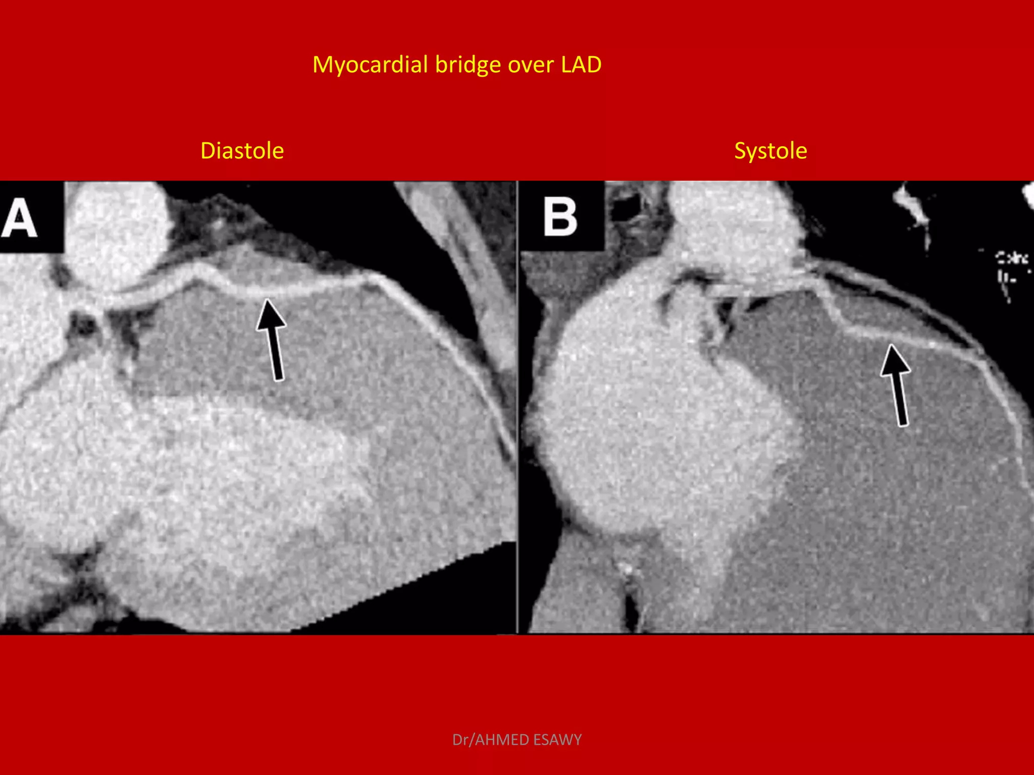 Role of MDCT MULTISCLICE CT tin coronary artery part 4 (anomalous ...
