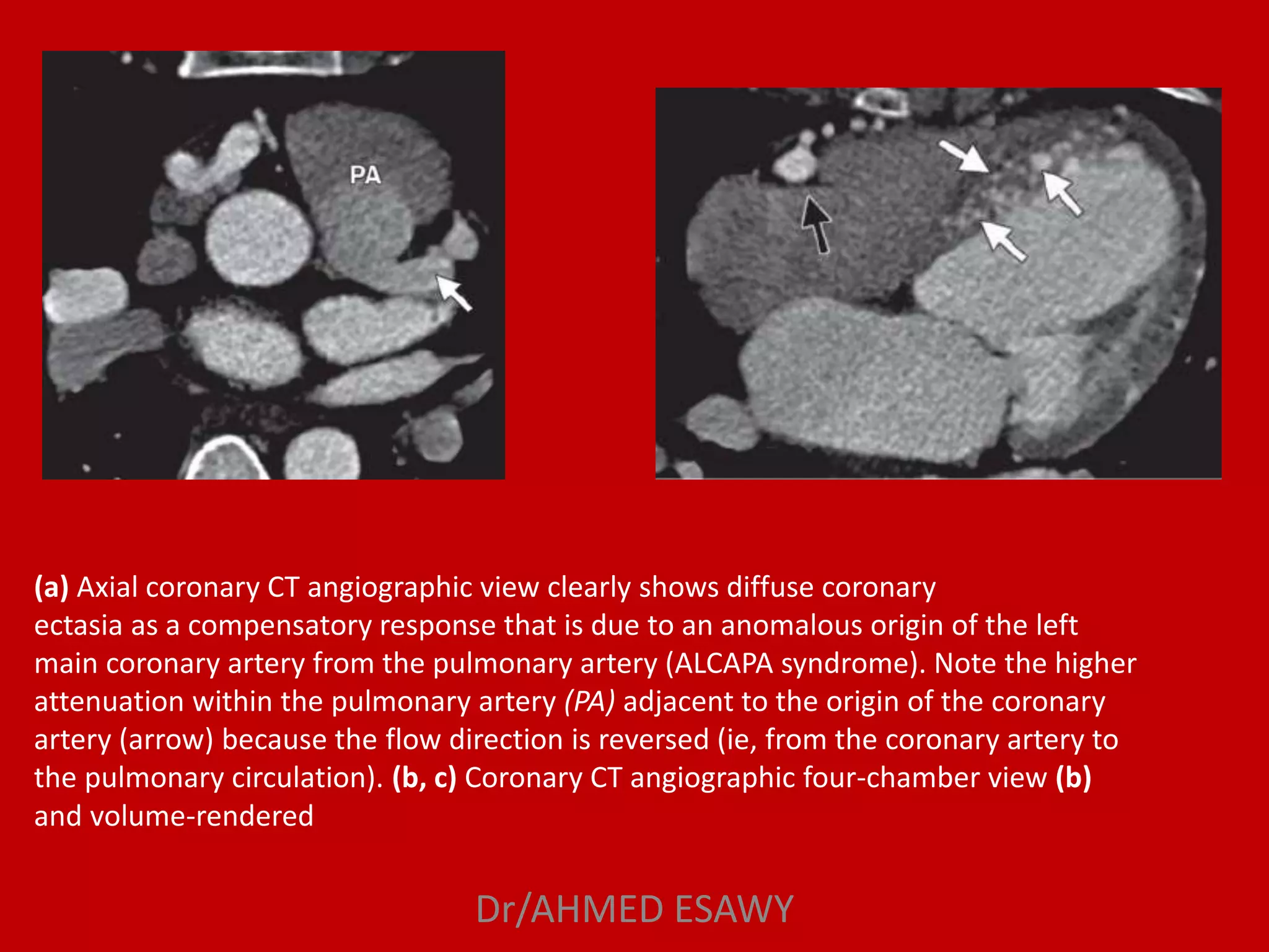Role of MDCT MULTISCLICE in coronary artery part 5 (non atherosclerotic ...