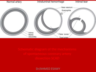 Role of MDCT MULTISCLICE in coronary artery part 5 (non atherosclerotic ...