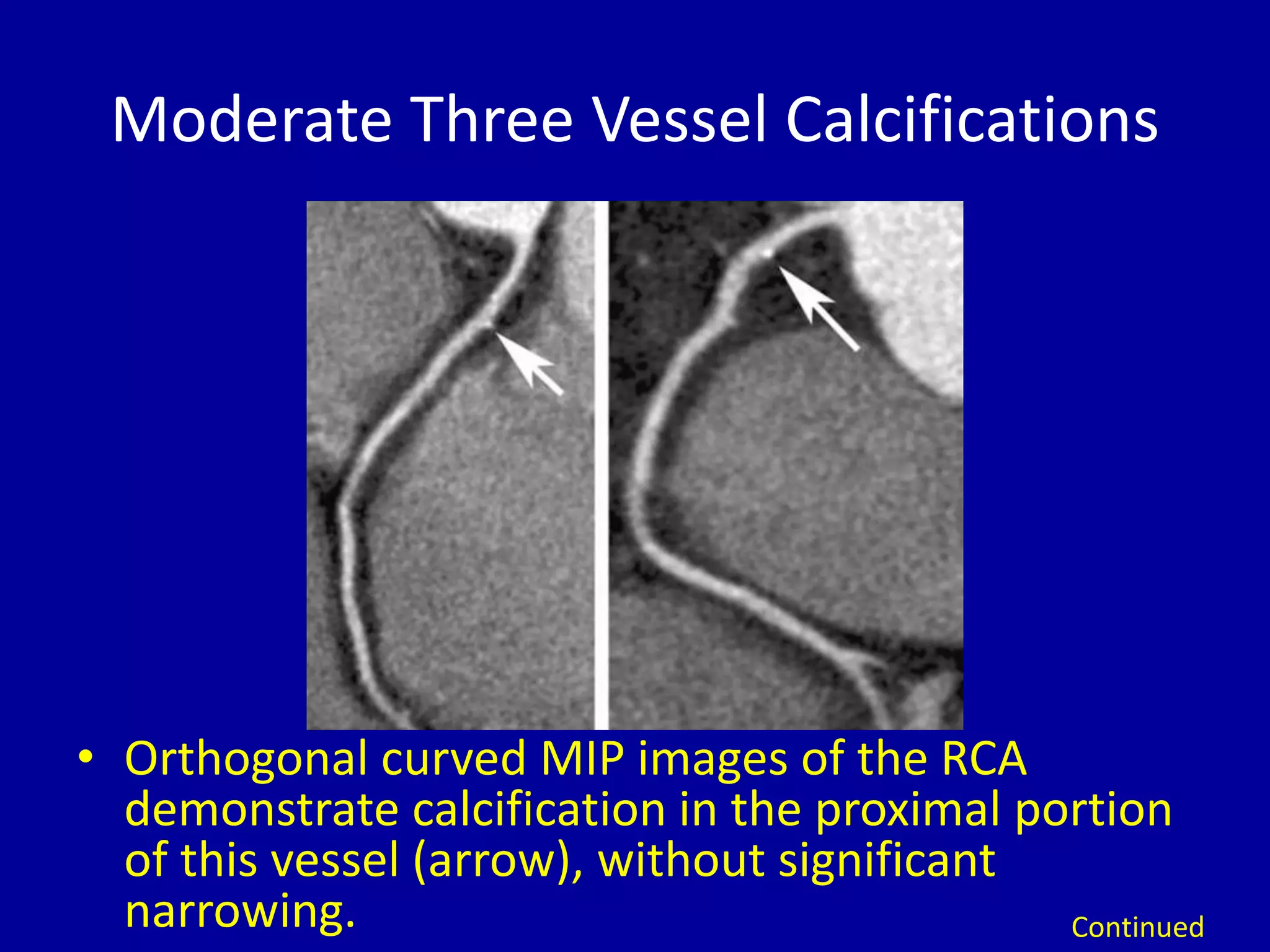 Role of mdct in coronary calcifications Dr. Muhammad Bin Zulfiqar | PPTX