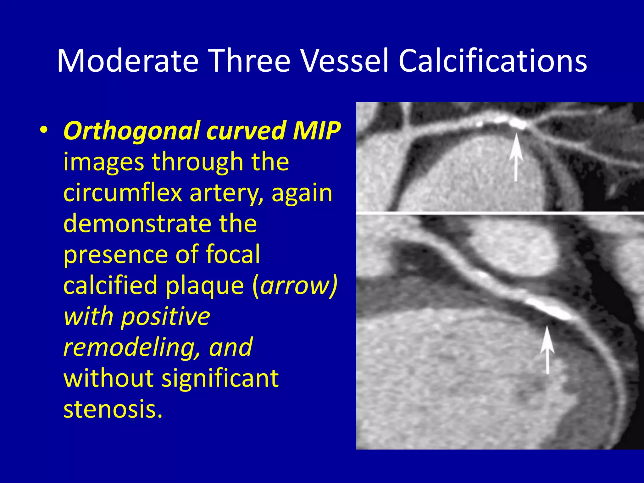Role of mdct in coronary calcifications Dr. Muhammad Bin Zulfiqar | PPTX