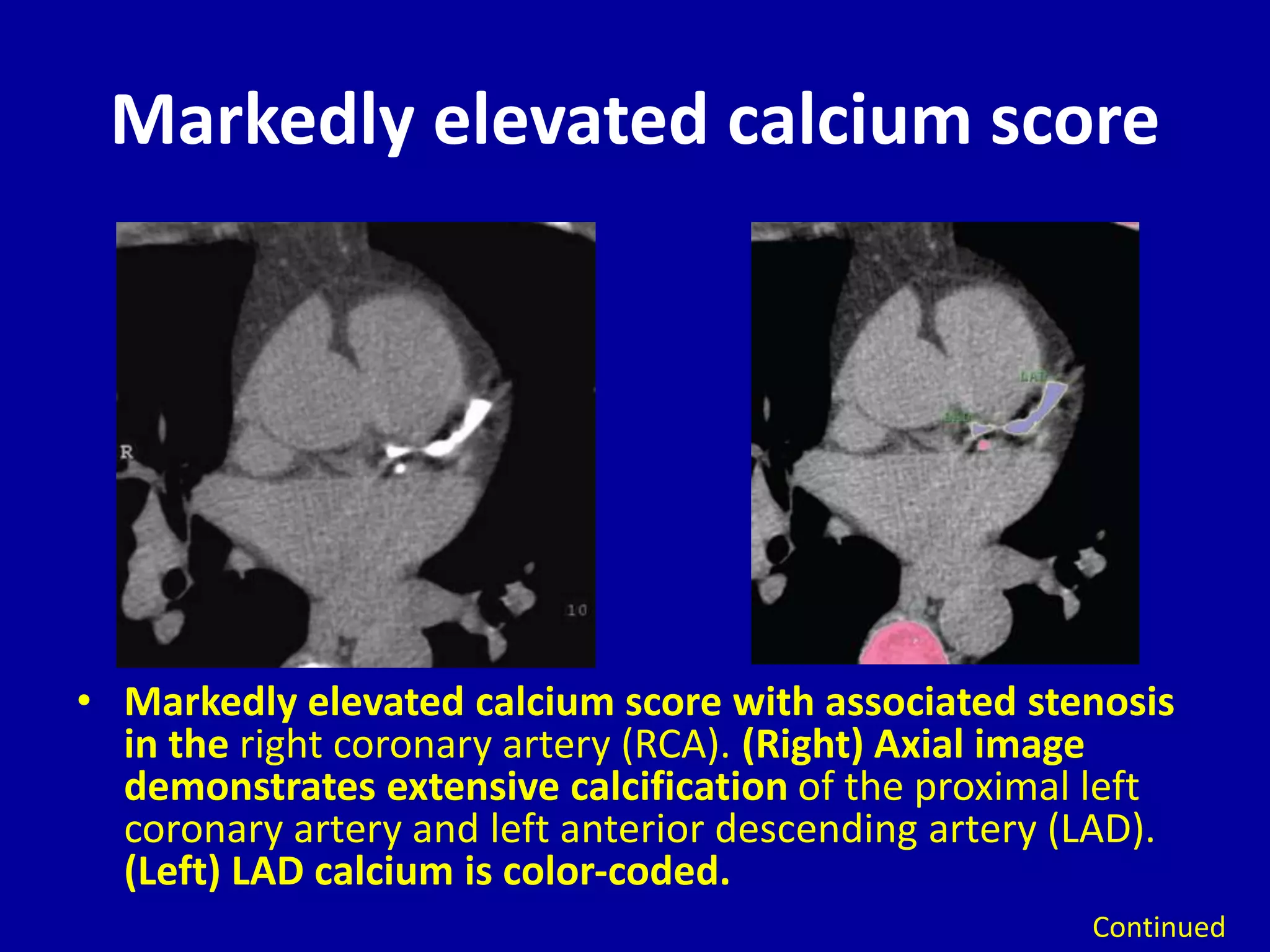 Role of mdct in coronary calcifications Dr. Muhammad Bin Zulfiqar | PPTX