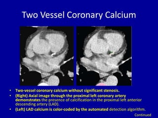 Role of mdct in coronary calcifications Dr. Muhammad Bin Zulfiqar | PPT