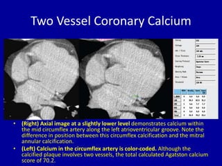 Role of mdct in coronary calcifications Dr. Muhammad Bin Zulfiqar | PPTX