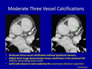 Role of mdct in coronary calcifications Dr. Muhammad Bin Zulfiqar | PPT