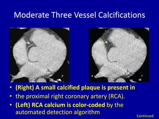 Role of mdct in coronary calcifications Dr. Muhammad Bin Zulfiqar | PPT