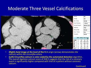 Role of mdct in coronary calcifications Dr. Muhammad Bin Zulfiqar | PPT