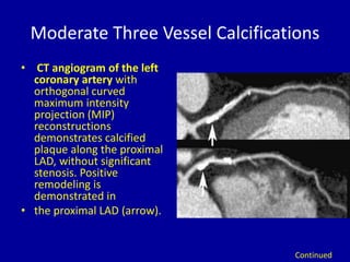 Role of mdct in coronary calcifications Dr. Muhammad Bin Zulfiqar | PPT