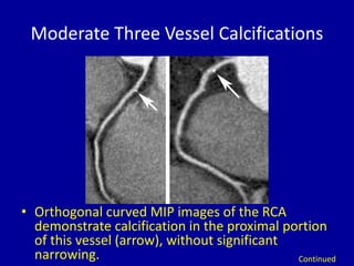 Role of mdct in coronary calcifications Dr. Muhammad Bin Zulfiqar | PPT