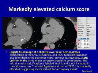 Role of mdct in coronary calcifications Dr. Muhammad Bin Zulfiqar | PPT