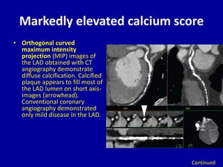 Role of mdct in coronary calcifications Dr. Muhammad Bin Zulfiqar | PPT