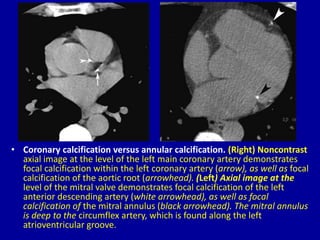 Role of mdct in coronary calcifications Dr. Muhammad Bin Zulfiqar | PPT