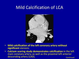 Role of mdct in coronary calcifications Dr. Muhammad Bin Zulfiqar | PPT