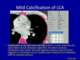 Role of mdct in coronary calcifications Dr. Muhammad Bin Zulfiqar | PPT