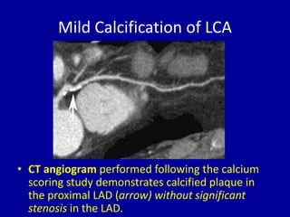 Role of mdct in coronary calcifications Dr. Muhammad Bin Zulfiqar | PPT