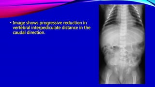 Role of Medical Imaging in Achondroplasia Dr. Muhammad Bin Zulfiqar | PPTX