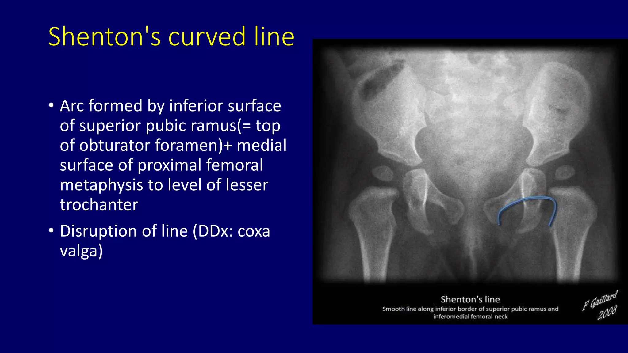 Role of medical imaging in developemental dysplasia of Hip Dr muhammad ...