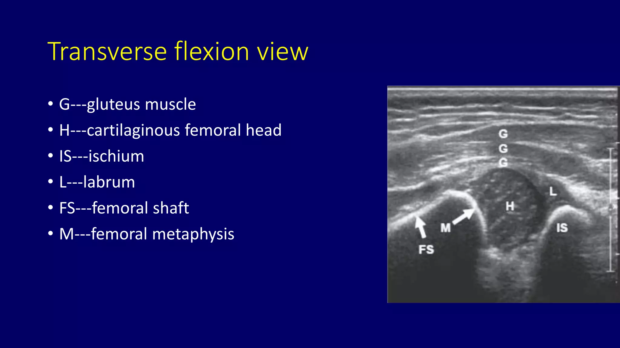 Role of medical imaging in developemental dysplasia of Hip Dr muhammad ...