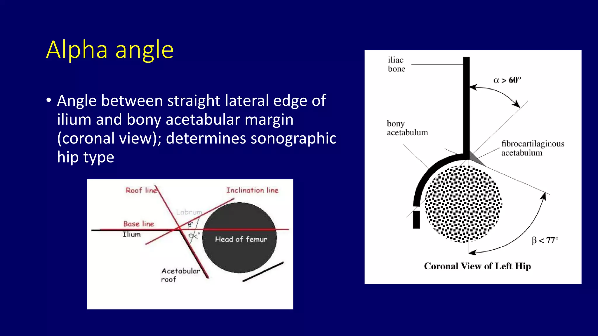 Role of medical imaging in developemental dysplasia of Hip Dr muhammad ...
