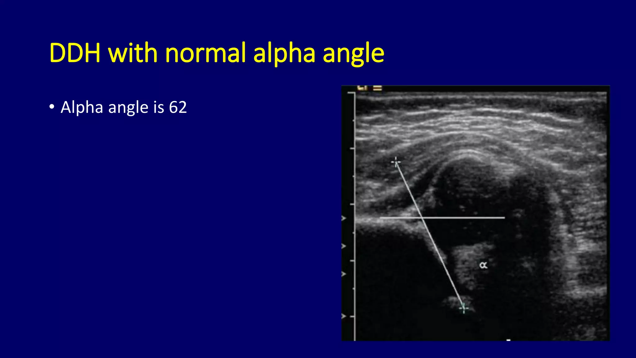 Role of medical imaging in developemental dysplasia of Hip Dr muhammad ...