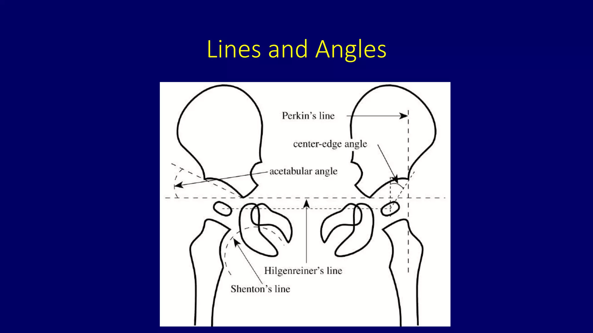 Role of medical imaging in developemental dysplasia of Hip Dr muhammad ...