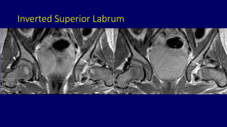 Role of medical imaging in developemental dysplasia of Hip Dr muhammad ...