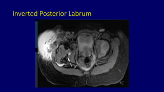 Role of medical imaging in developemental dysplasia of Hip Dr muhammad ...