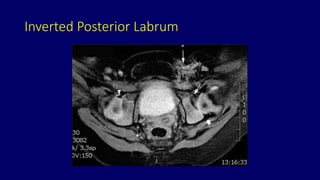 Role of medical imaging in developemental dysplasia of Hip Dr muhammad ...