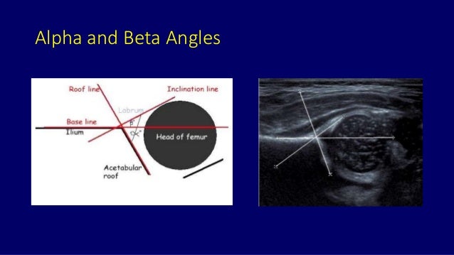 Role of medical imaging in developemental dysplasia of Hip Dr muhamma…