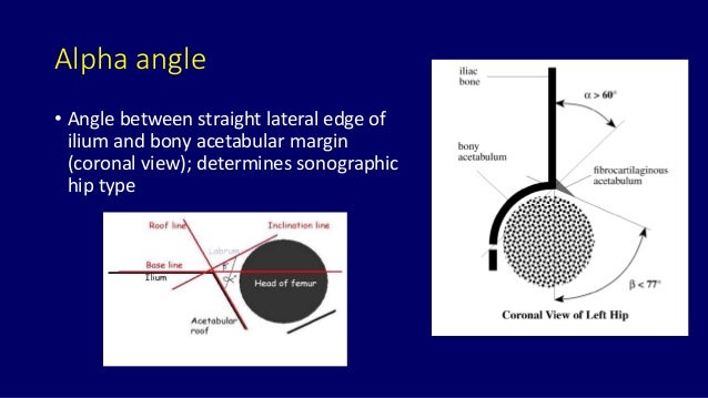 Role of medical imaging in developemental dysplasia of Hip Dr muhamma…