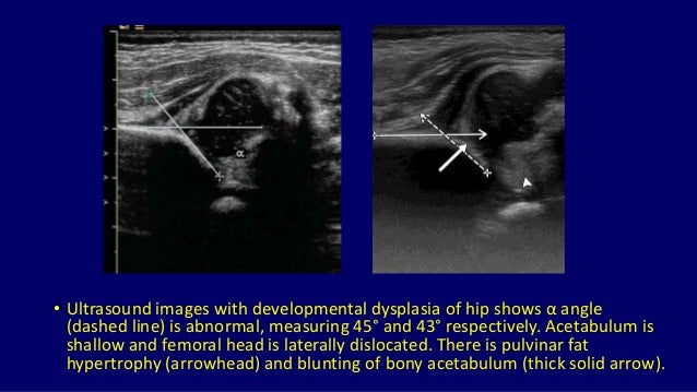 Role of medical imaging in developemental dysplasia of Hip Dr muhamma…