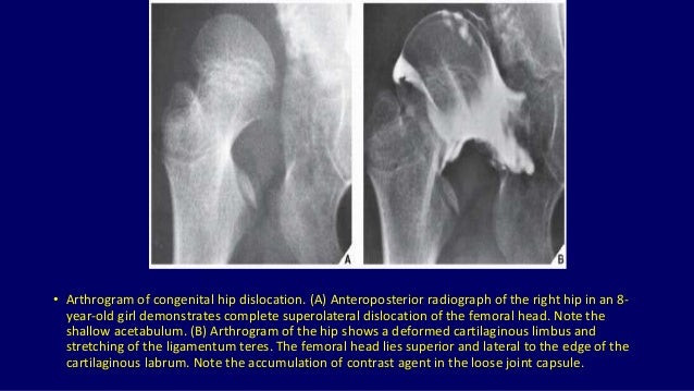 Role of medical imaging in developemental dysplasia of Hip Dr muhamma…