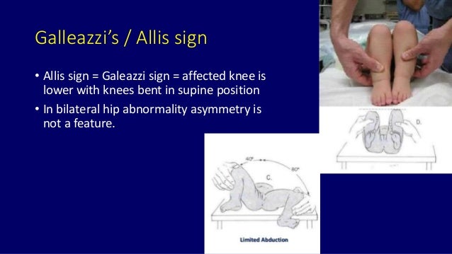 Role of medical imaging in developemental dysplasia of Hip Dr muhamma…