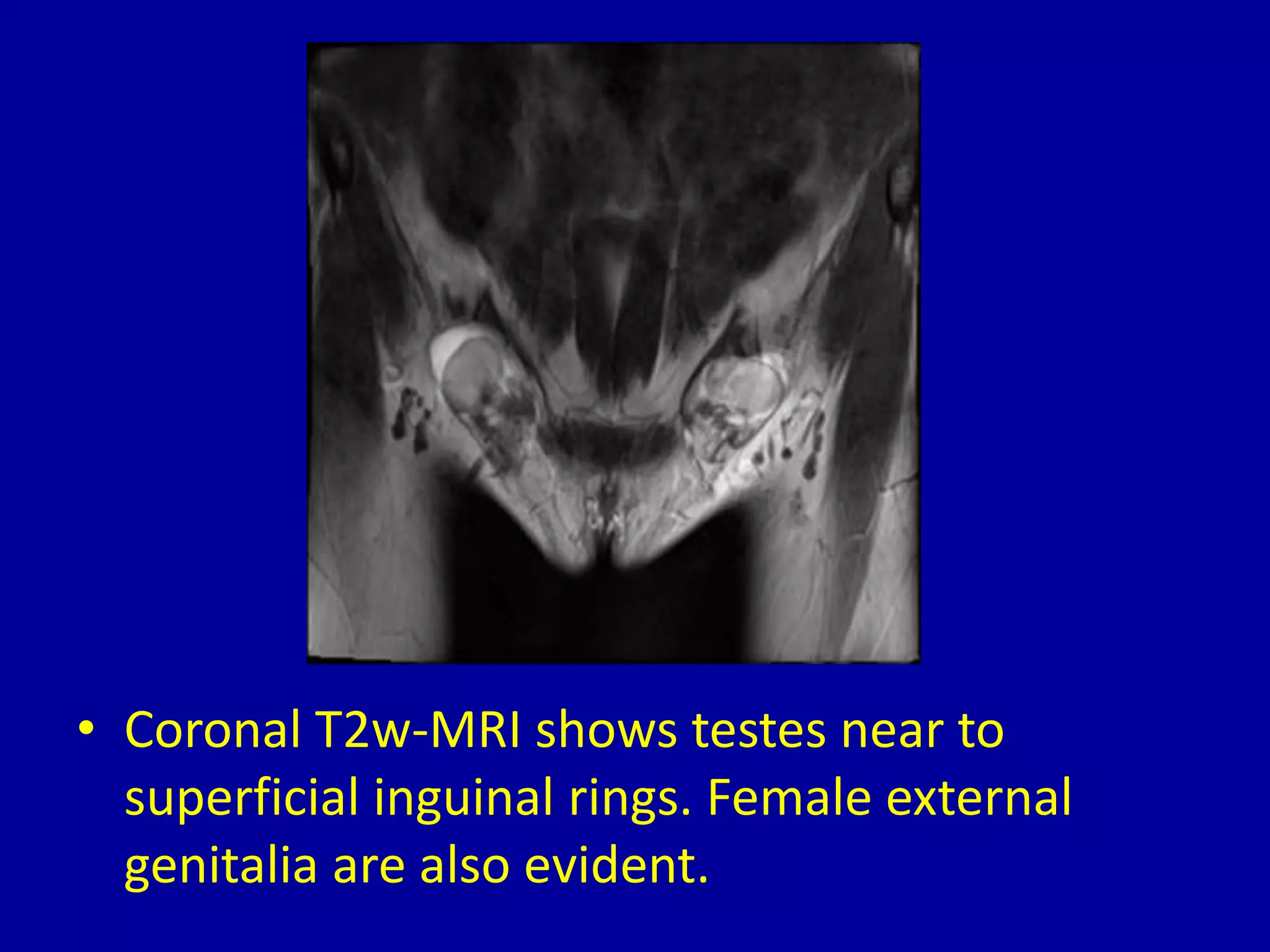 Role of medical imaging in diagnosing ais and presurgical assesment in ...