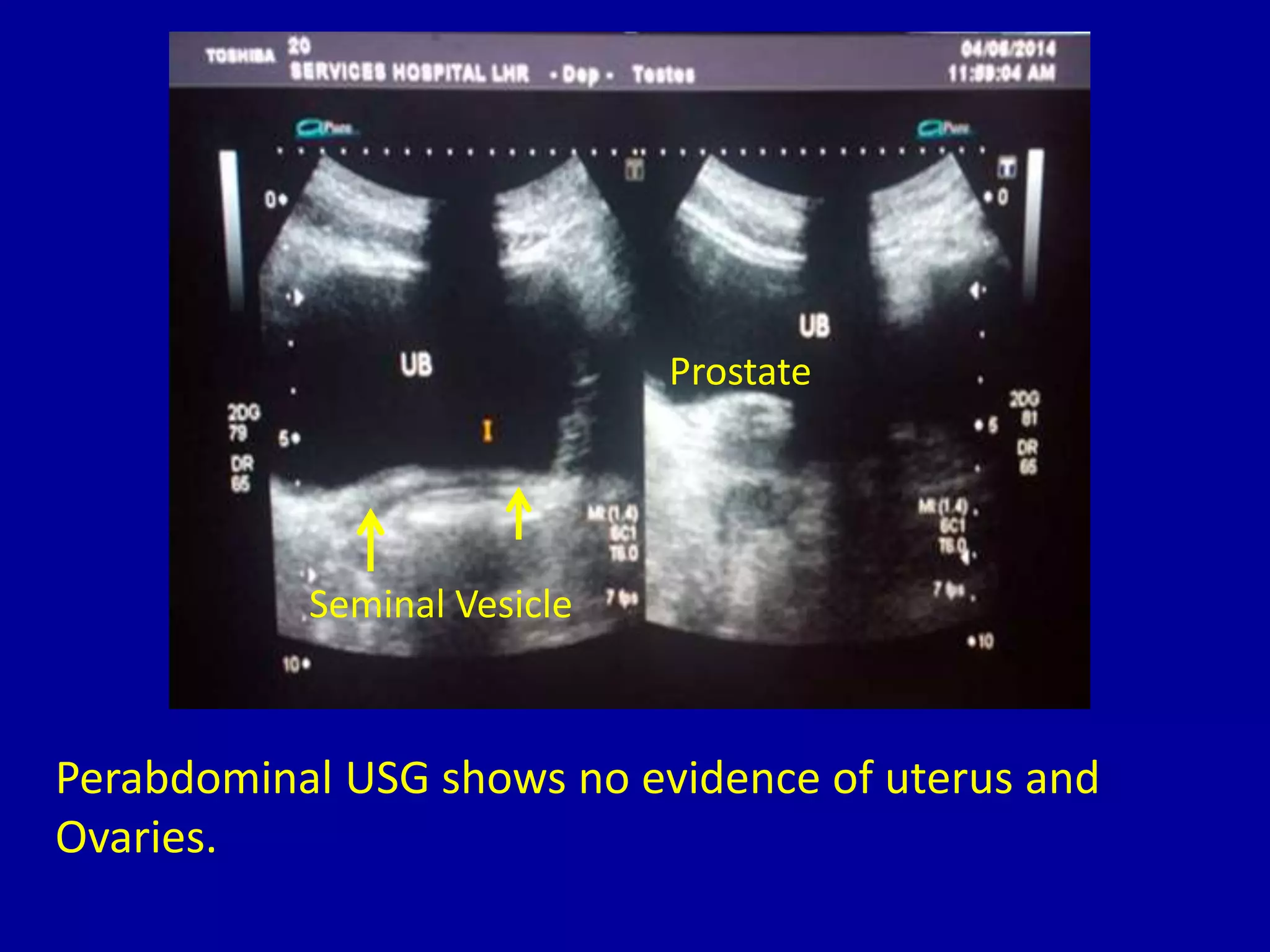 Role of medical imaging in diagnosing ais and presurgical assesment in ...