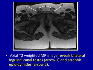 Role of medical imaging in diagnosing ais and presurgical assesment in ...