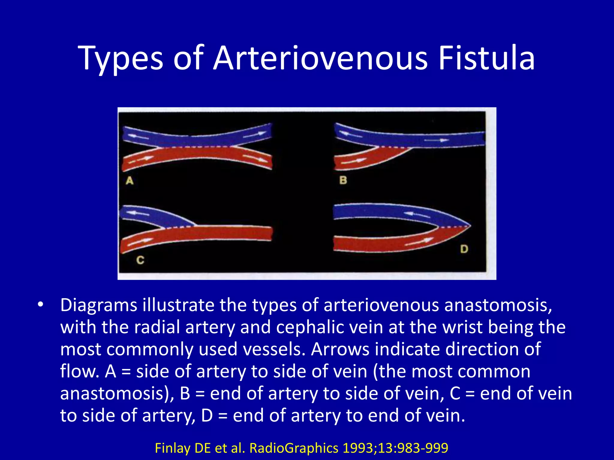 Role of medical imaging in management of arteriovenous fistula Dr ...