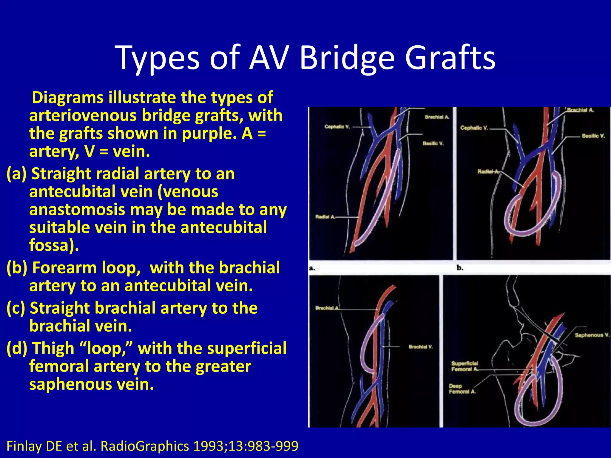Role of medical imaging in management of arteriovenous fistula Dr ...