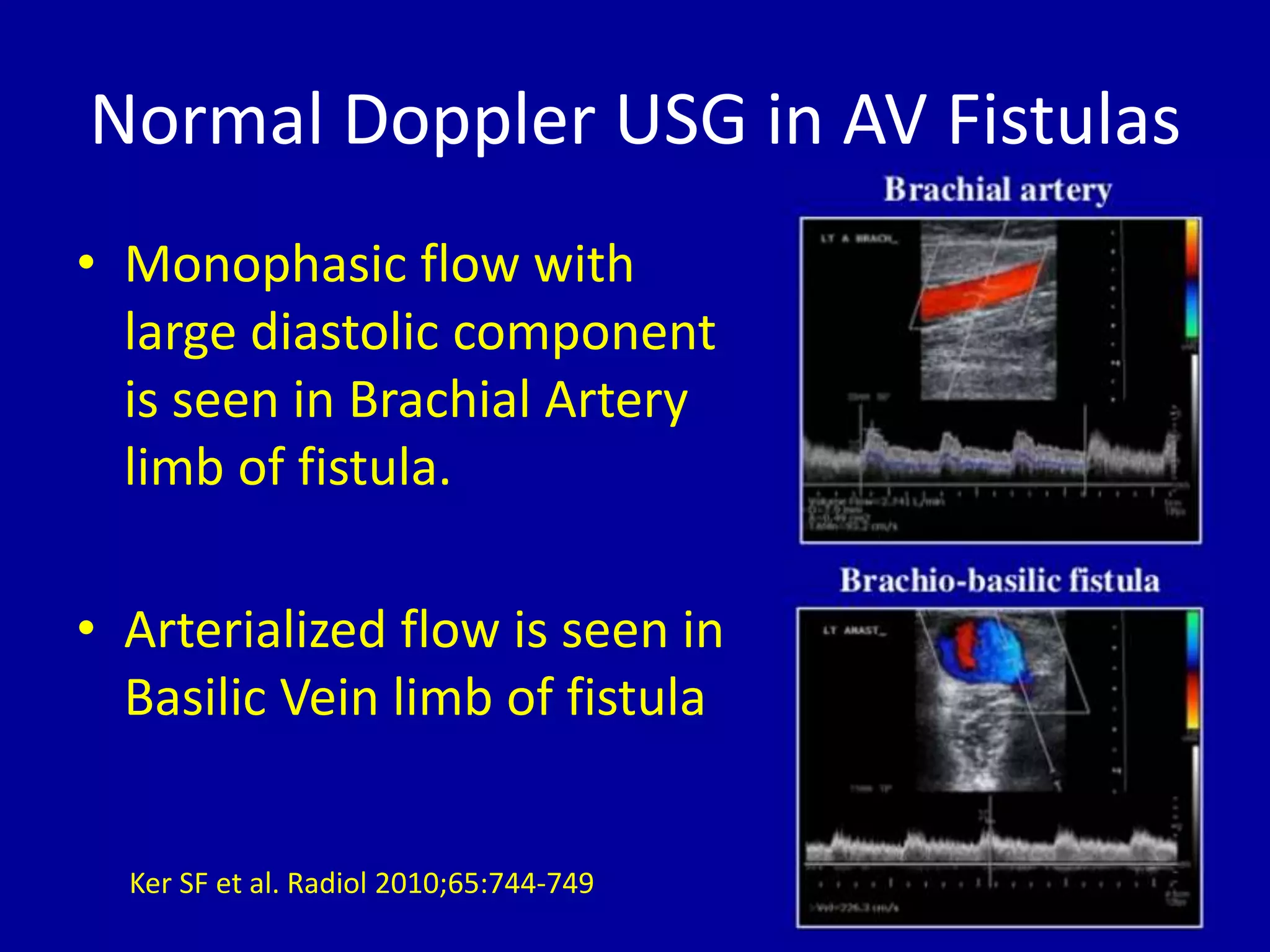 Role of medical imaging in management of arteriovenous fistula Dr ...