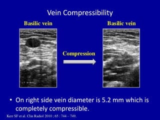 Role of medical imaging in management of arteriovenous fistula Dr ...