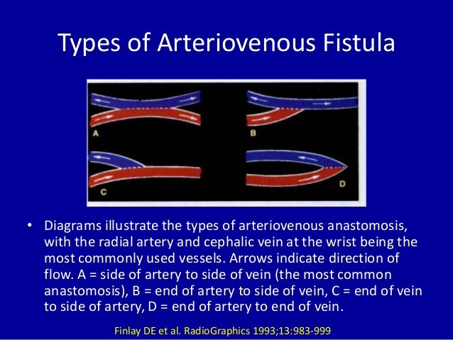 Role of medical imaging in management of arteriovenous fistula Dr. Mu…