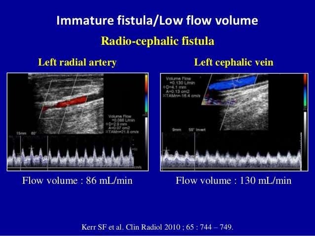 Role of medical imaging in management of arteriovenous fistula Dr. Mu…